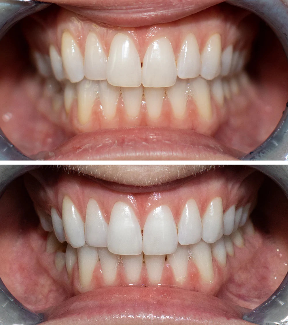 Oil Pulling Before And After